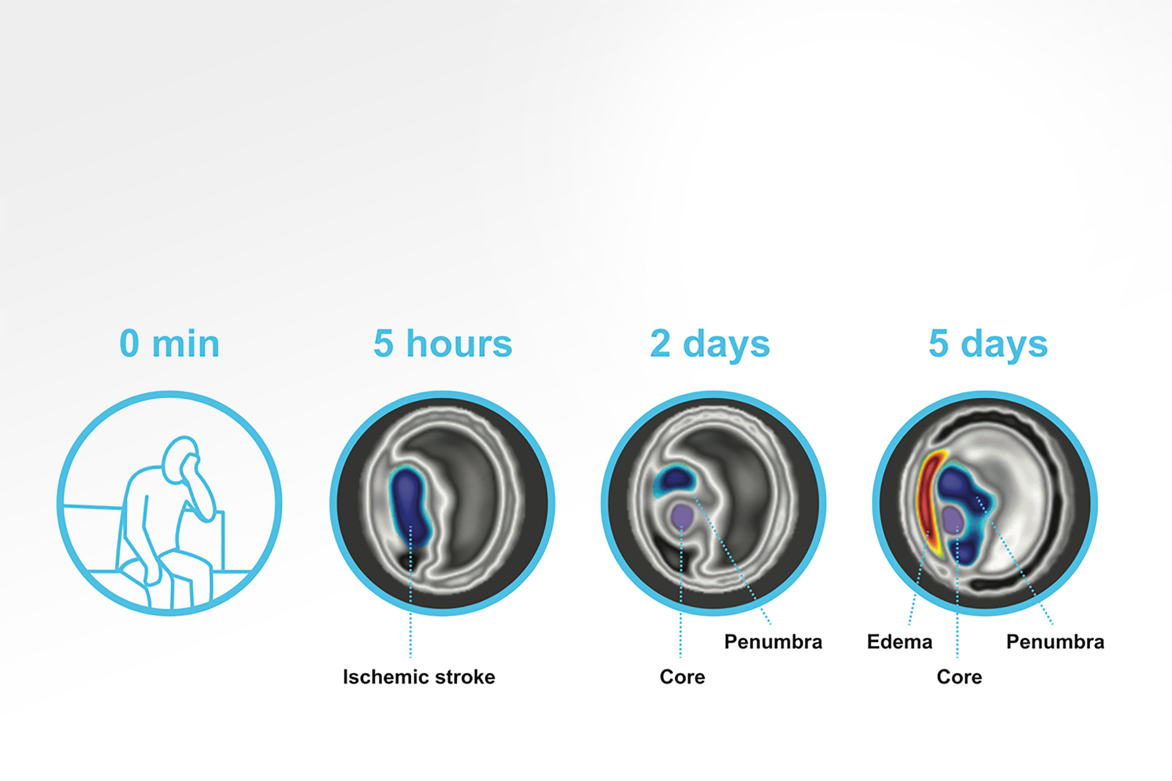 Continuous 24/7 Brain Imaging of Stroke Patients - EMTensor